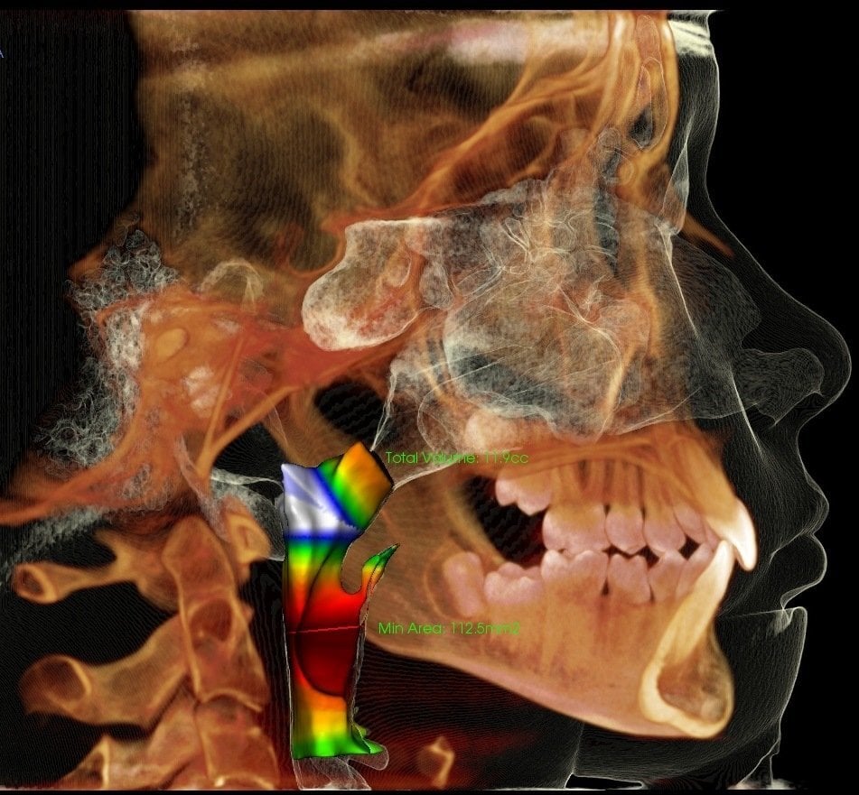 3D Airway Analysis Fulton MD, Maple Lawn Orthodontics